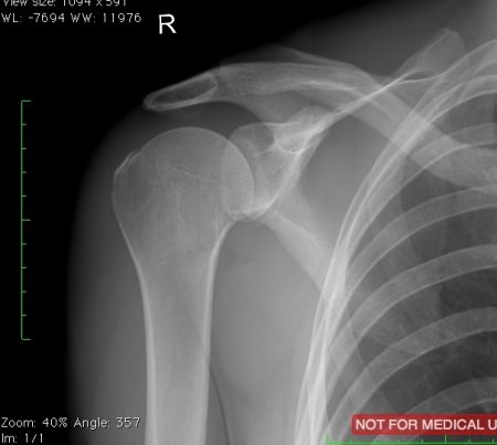 Omalgia postraumática - Ecografía Deportiva