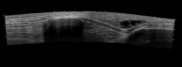 Bursitis rodilla - Ecografía Deportiva