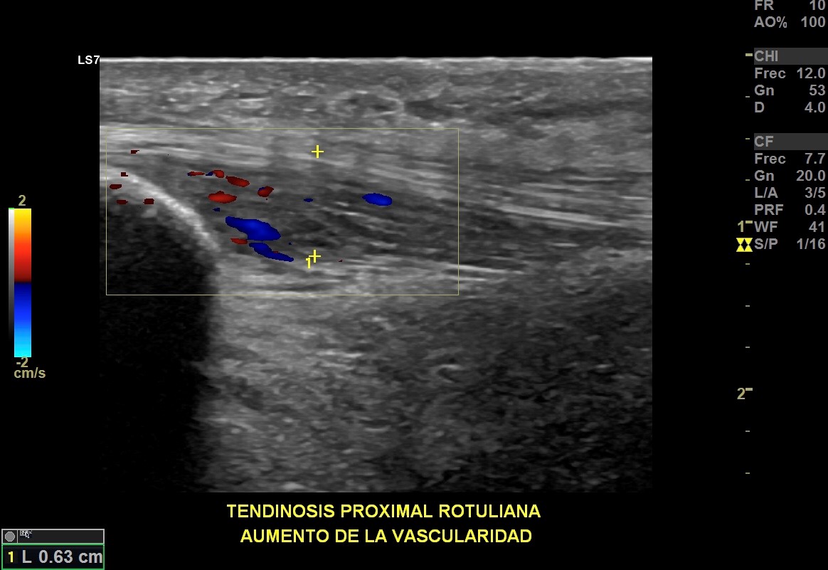 Tendinosis rotuliana - Ecografía Deportiva