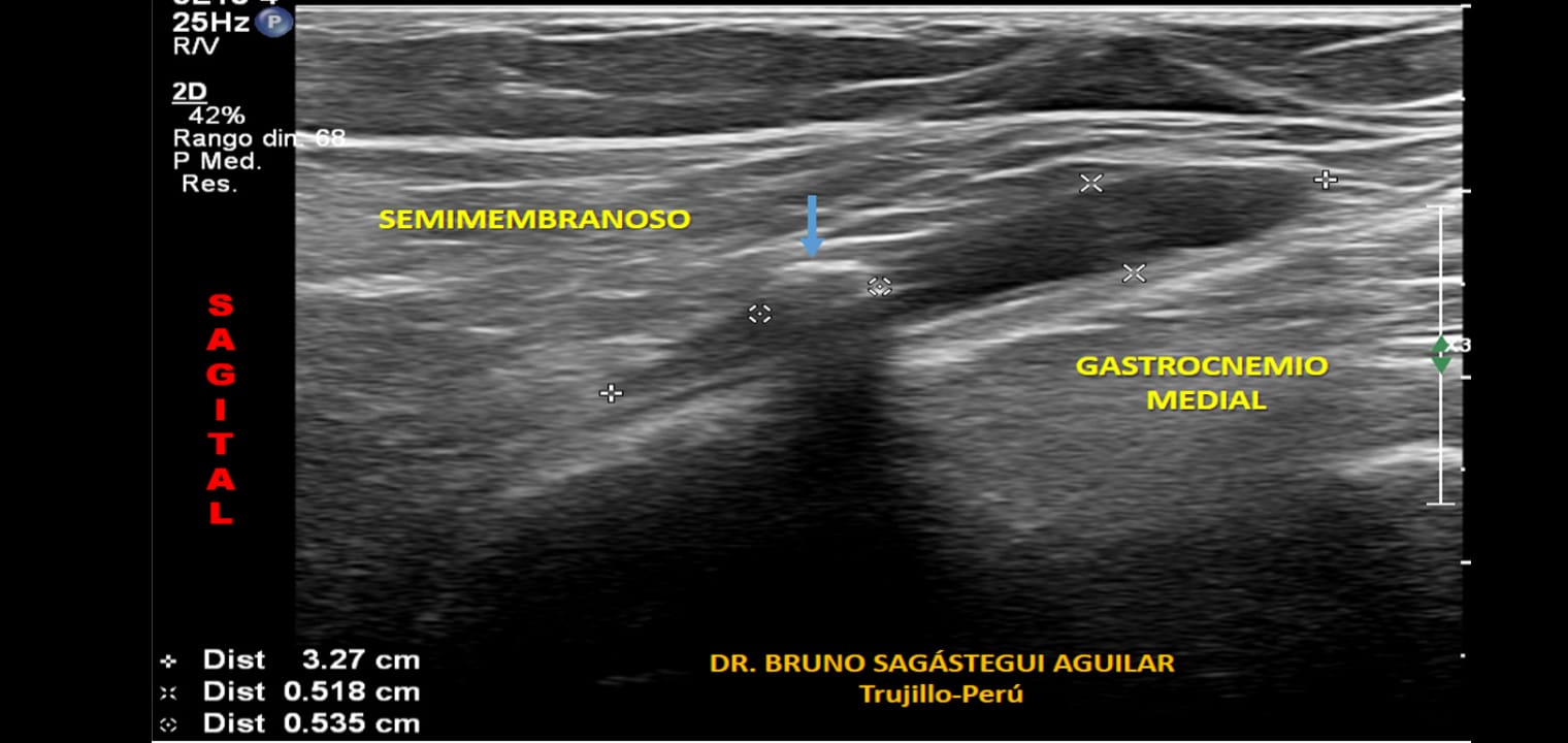 Quiste de Baker en rodilla - Ecografía Deportiva