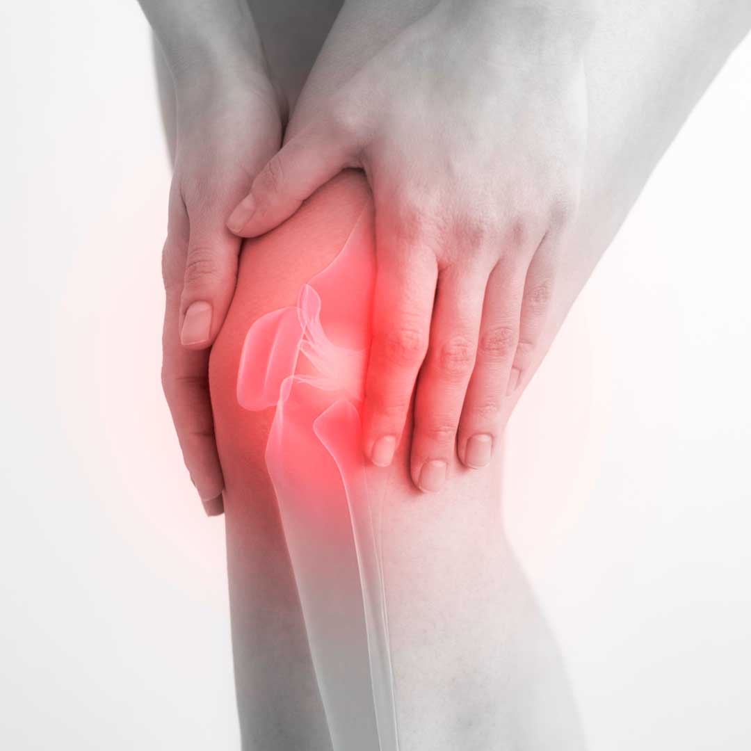 Rotura completa del ligamento colateral medial. - Ecografía Deportiva